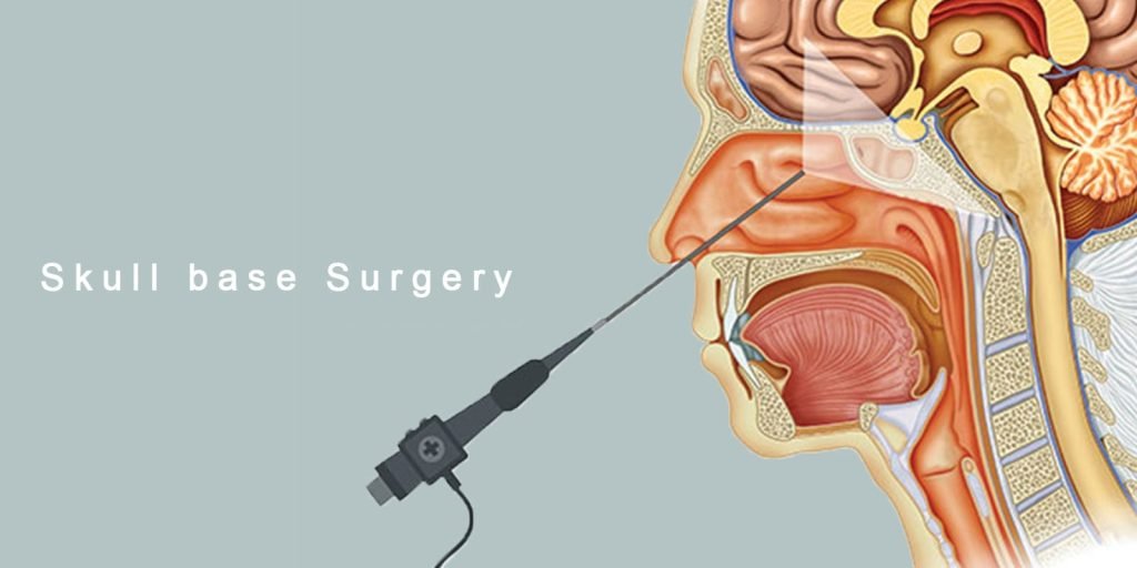 Skull Base Surgery Neurospine Hospital And Revive Critical Care