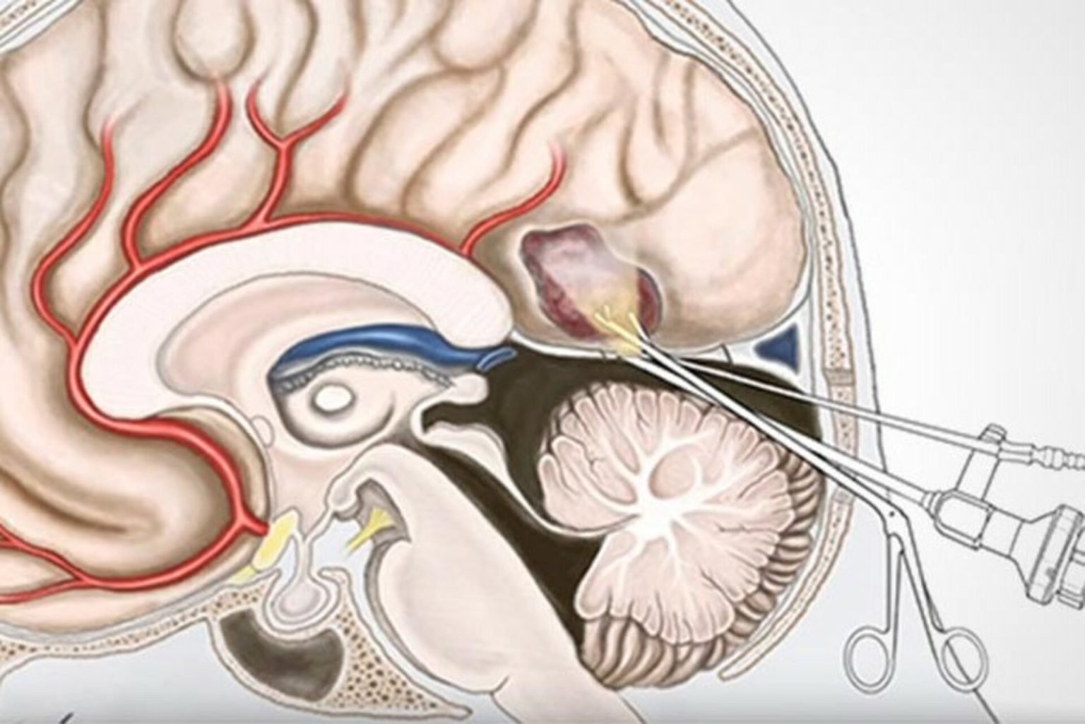 Endoscopic Brain Surgery - Neurospine Hospital & Revive Critical Care